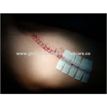 China Disposable advanced wound care skin stapler for wounds emergency ...