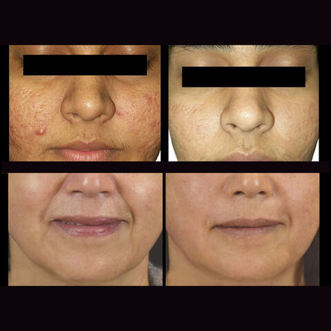 Buy Wholesale China Face Lifting Pdo Thread Collagen Hilos Cog 4d 21g ...