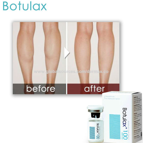 Buy Wholesale China Botox Masseter ,botulax' 100 Units, Original ...