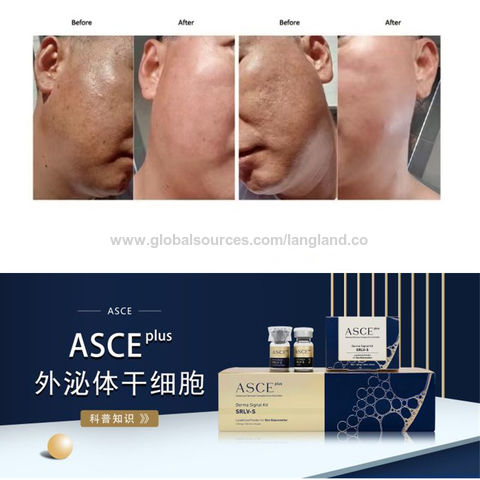 Buy Wholesale China Asce Plus Derma Signal Kit Srlv-s Good Effect For ...