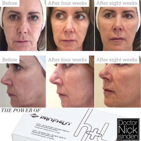 Buy Wholesale China Profhilo Injection Profhilo Face Lifting ...