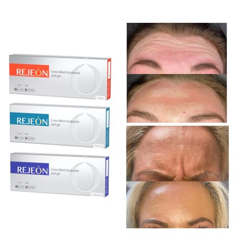 Buy Wholesale China Anti-aging Rejeon Chin Injection Lip Enhancement ...