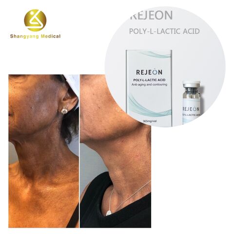 Buy Wholesale China Plla Polyllactic Acid Remove Neck Lines/rejeon Plla ...