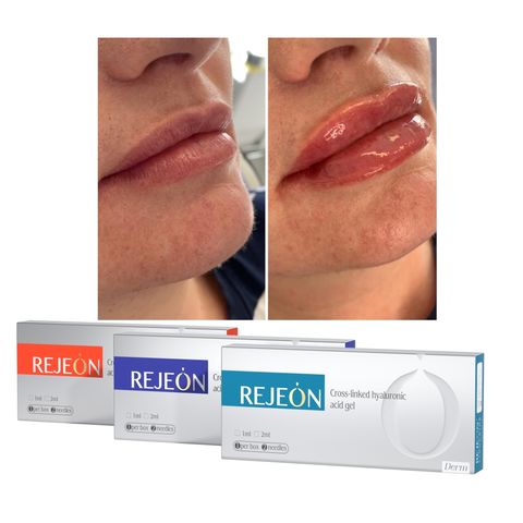 Buy Wholesale China Factory Making China 1ml Ce Approved Hyaluronic Acid Injection Lip ...