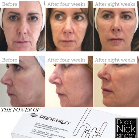 Buy Wholesale China Original Genuine Profhilo To Lift Face Skin And ...