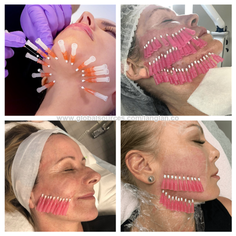 Buy China Wholesale Supplier Manufacturer Absorbable Face Pdo Thread Lifting V-line Skin ...