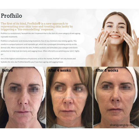Buy Wholesale China Original Genuine Profhilo To Lift Face Skin And ...