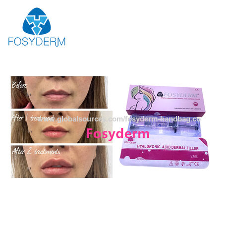 Buy Wholesale China Lip Filler Fosyderm 2ml Derm Line Hyaluronic Acid ...
