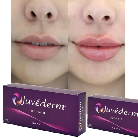 Buy Wholesale China Juve Derm Fillers For Wrinkles 1ml Lip Filler Ultra ...