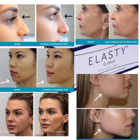 Buy Wholesale China Supply Korea Elasty Injectable Wrinkle Removal 2ml Elasty F Plus Dermal ...