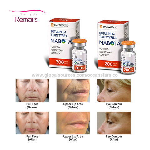 Buy Wholesale China Korea Origin Cheap Price Nabota Wiztox Meditoxin ...