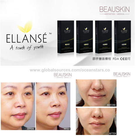 Buy Wholesale China Original Ellanse S M L For Anti Aging Wrinkles ...