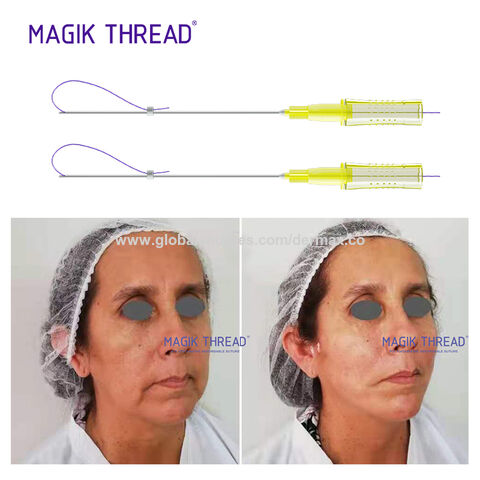 Buy Wholesale China Pdo Thread Lift Abdominal Medical Suppliers Non ...