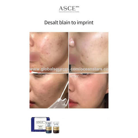 Buy Wholesale China Korea New Product Asce Plus Derma Signal Kit Srlv-s ...
