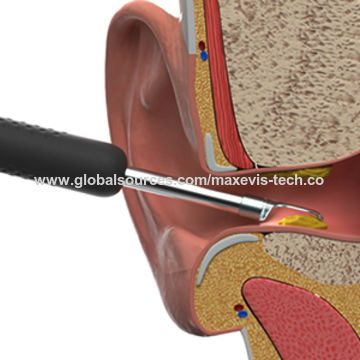 China Ear scrapers Ear Wax Removal with camera Earwax Removal Tool ...