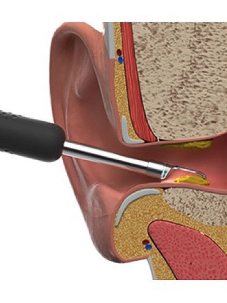 China Ear scrapers Ear Wax Removal Cleaner Otoscope WiFi Ear Camera Ear ...