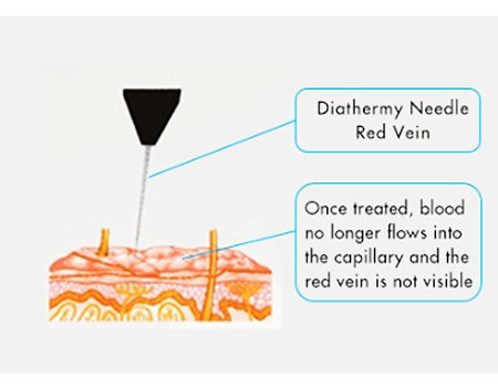 China Vascular removal beauty machine thermocoagulation thread vein ...