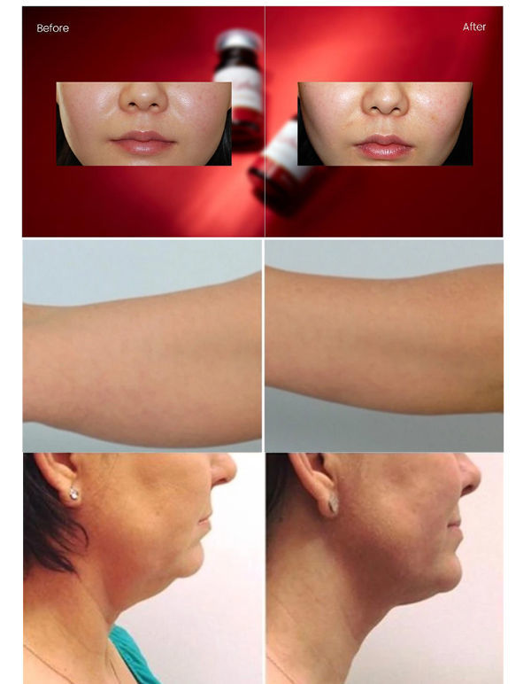 China New Product Fat Dissolver Body Slimming Original Kabelline ...