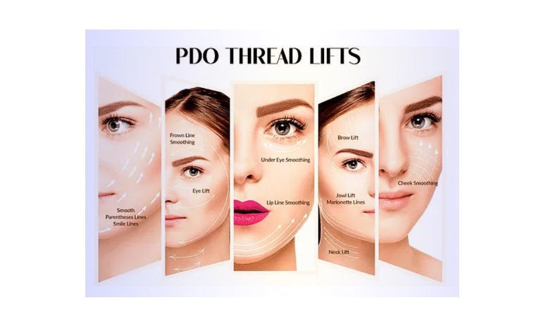 Hot Sale 30G 25mm Lips Fillers PDO Threads Screw, Hot Sale 30G 25mm 30G ...