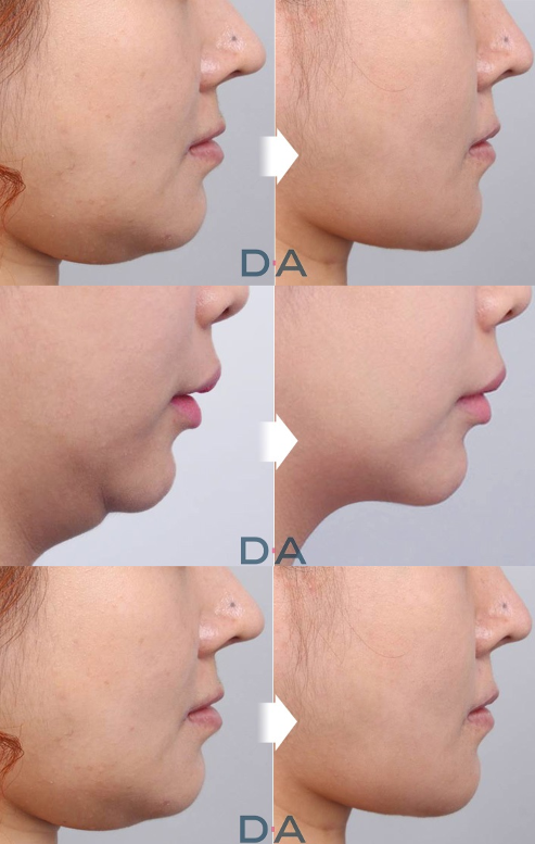 China Slimming Injection Lipolysis Injection Kybella for Fat Dissolve ...