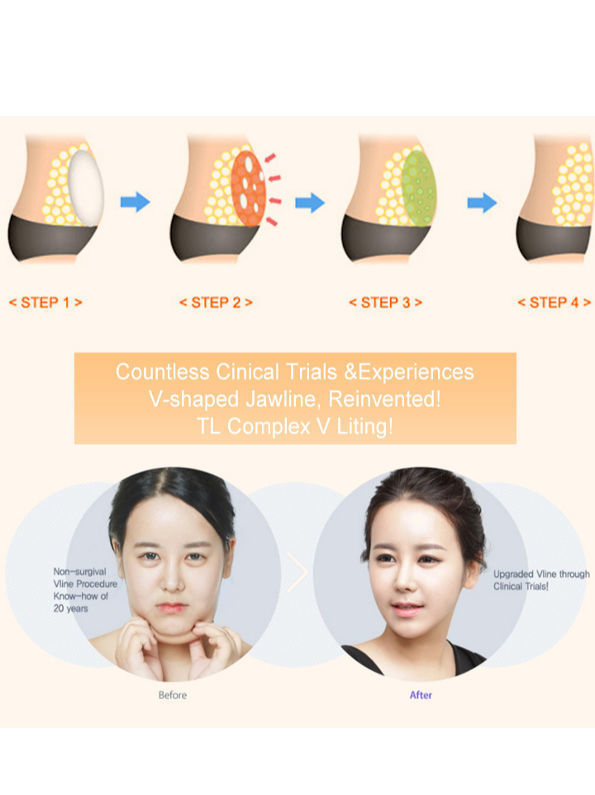 China Lipolysis Injection Body Contouring Kabelline Lipo Lab Ppc ...