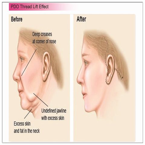 China Manufacturer PCL PDO Fishbone thread molding type 18g100mm for ...