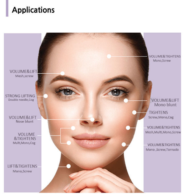 China Manufacturer PCL PDO Fishbone thread molding type 18g100mm for ...