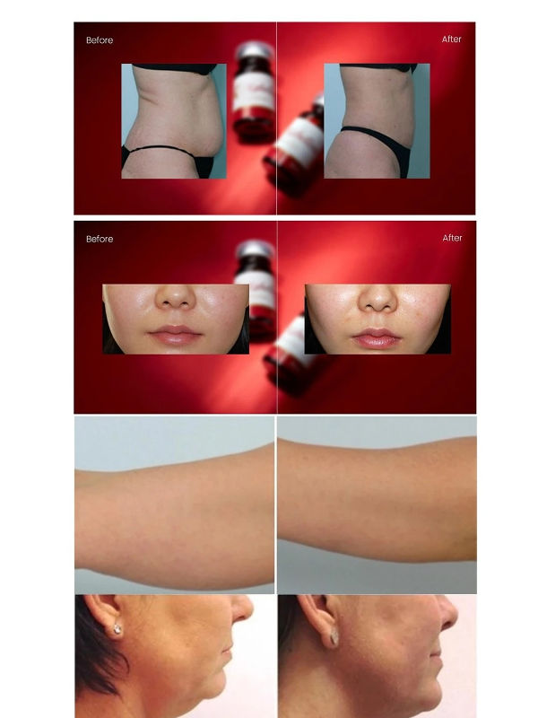 2021hot selling new products kabelline fat dissolving injection ...