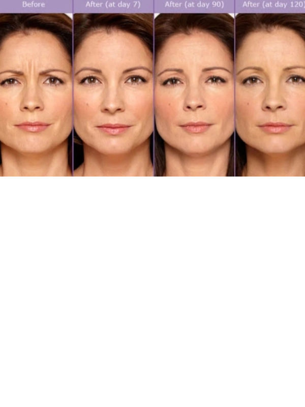 Innotox 50u/100u Korea Factory Price Botulinum Meditoxin New Product ...