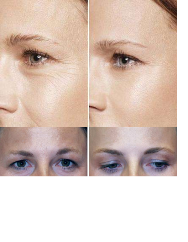 Innotox 50u/100u Korea Factory Price Botulinum Meditoxin New Product ...