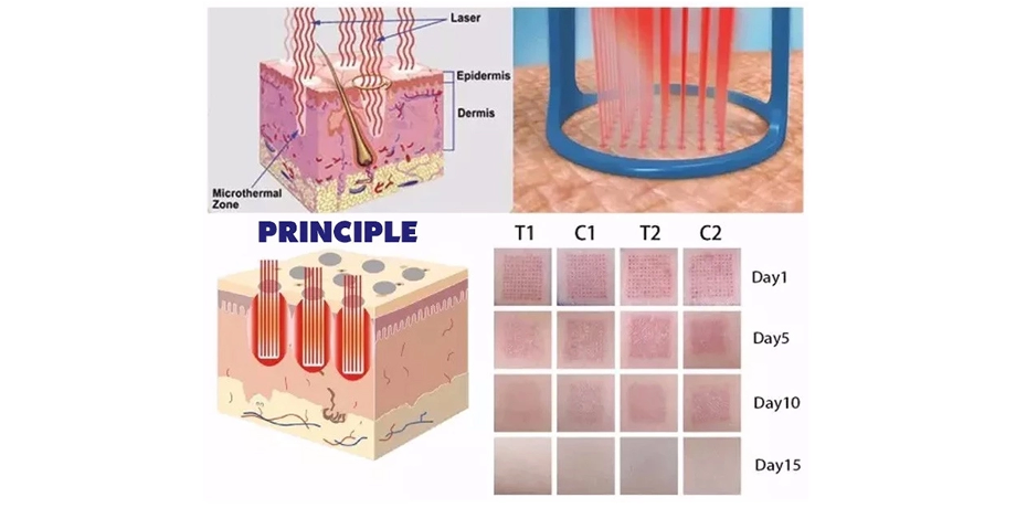 China Medical equipment er yag ablative laser 2940nm erbium laser anti ...