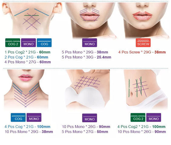 Mono 27g 50mm Korea Pdo Thread Lifting Mono for Medical Skin Tightening ...