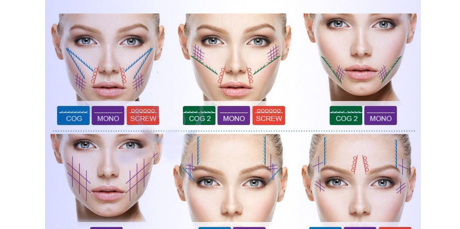 China 3d pdo thread 4D Cog Thread L Blunt cannula face lift thread for ...