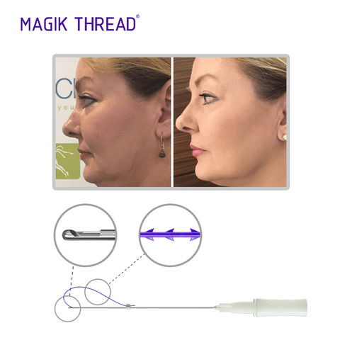 China Pdo Thread Wrinkle Filling Pdo Mesh Fill Thread Lift Seul Korean ...