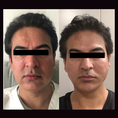 China Face lifting tightening thread embedding threading mini cog screw ...