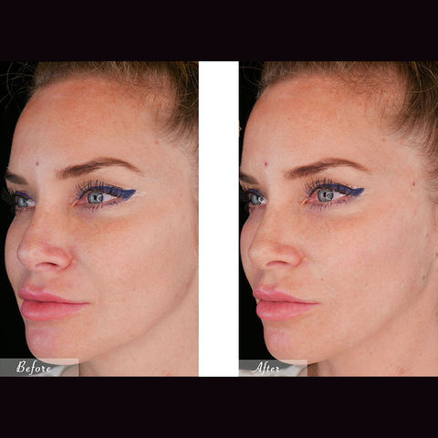 China Korea threads face lift 27G cog lift mono threads long lasting ...