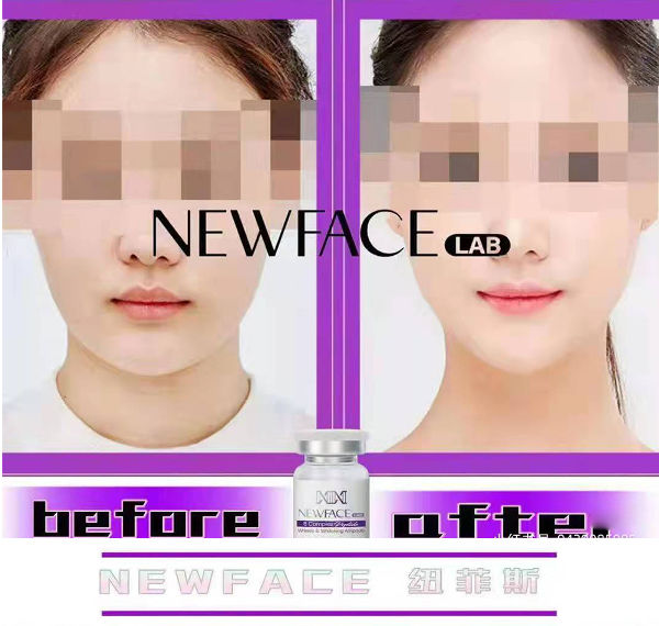 King lifting Korea New Face lab pcl filler collagen hyaluronic acid ...