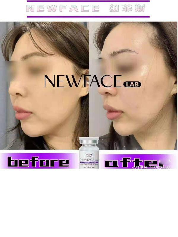 King lifting Korea New Face lab pcl filler collagen hyaluronic acid ...
