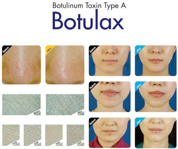 Korea origin High repurchase rate injectable Factory Outlet Botu lax ...