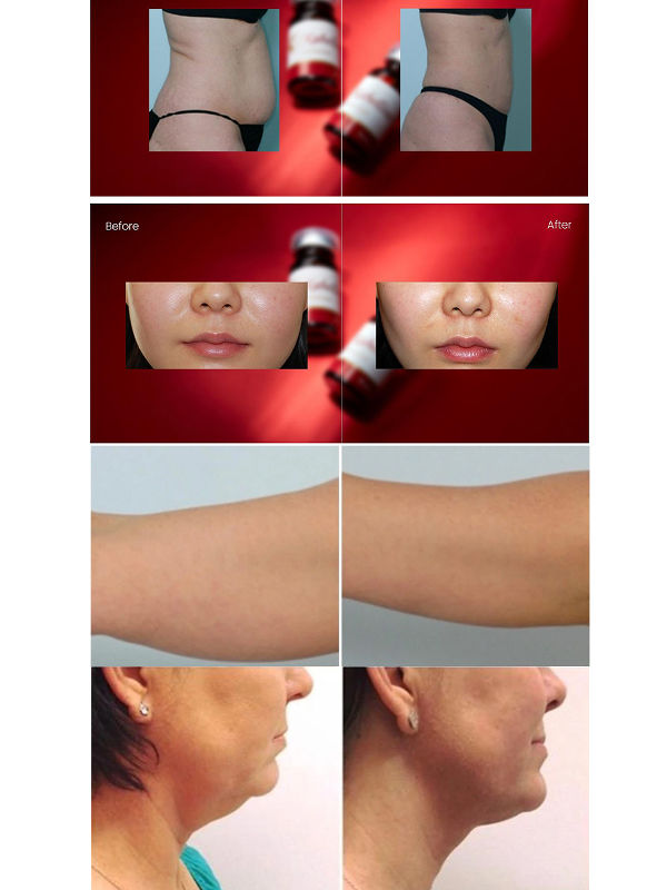 Lipolytic Kabelline Fat Dissolver Injection Product with High Purity DC ...