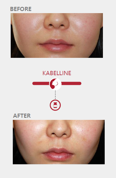 CE Certification Mesoterapia Kabelline Fat Dissolving Injection Lipo ...