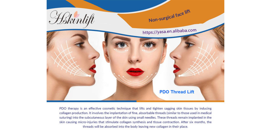 Plla Pcl Fishbone Molding Pdo face-anti aging threads face lifting ...