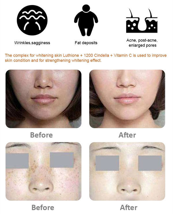 Whitening Injection Cindella Luthione Thioctic Acid Glutathione Vitamin ...