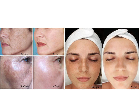 Acne & Blemish Treatment Skin Purifying Face Hyperpigmentation Korean ...