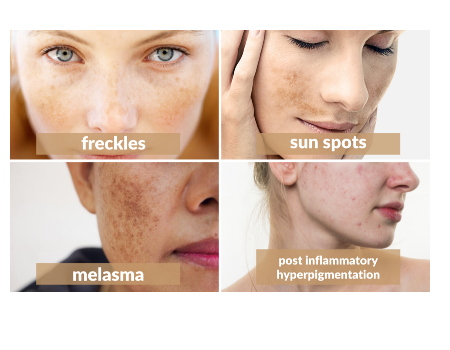 Acne & Blemish Treatment Skin Purifying Face Hyperpigmentation Korean ...