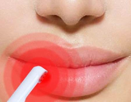 Red Light Therapy for Cold Sore and Canker Sore, 660nm, 850nm, Near ...