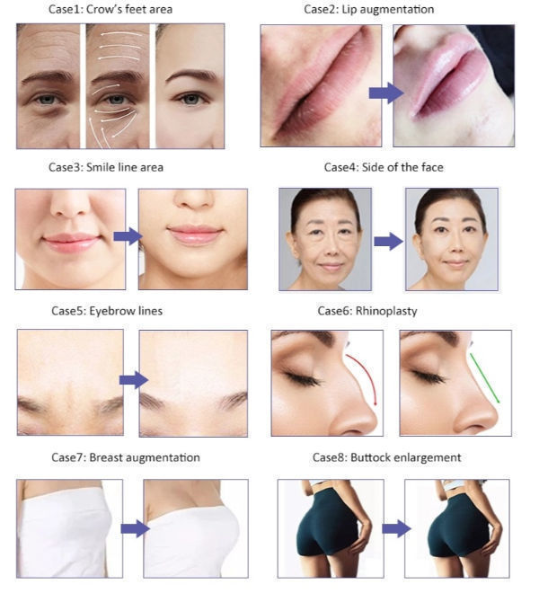 Hyaluronic Acid Dermal Fillers for Facial Fine Line Injection ...