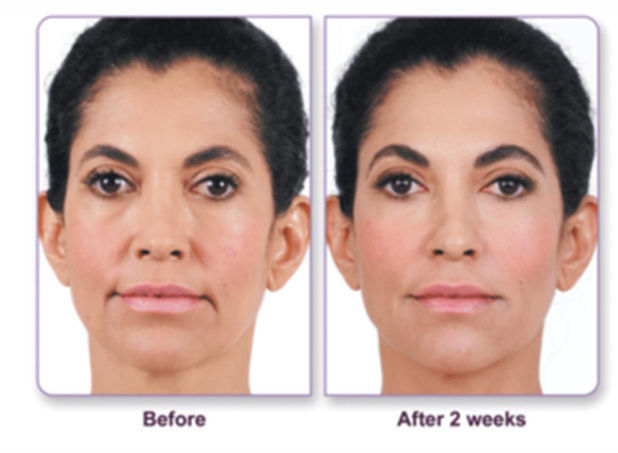 Juve 2ml ha injectable dermal filler gel long lasting face deep face ...