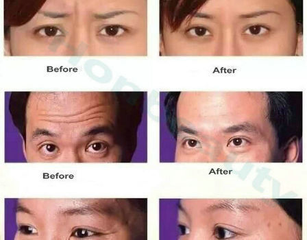 Buy Wholesale China 2022 Botulaxs Meditoxin Neronox Novatox Injectable ...