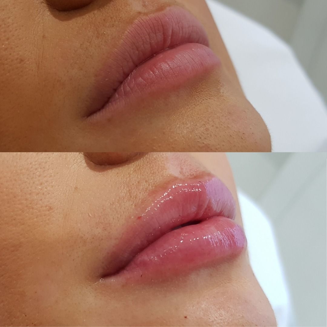 Buy Wholesale China Original Rejeunesse Lip Filler For Pen Cheap Dermal ...